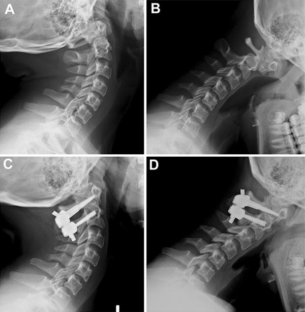 Treatment of pediatric atlantoaxial instability with traditional and ...