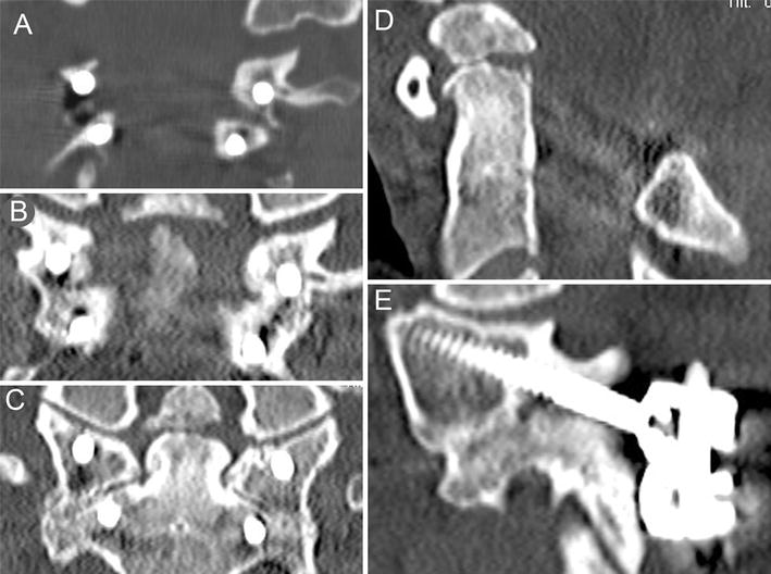 Treatment of pediatric atlantoaxial instability with traditional and ...