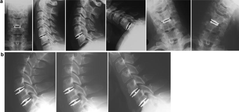 Intermediate clinical and radiological results of cervical TDR (Mobi-C ...
