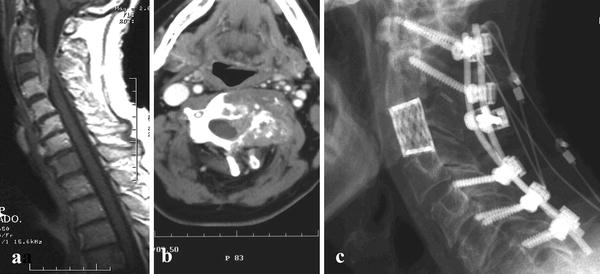 Posterior transpedicular corpectomy for malignant cervical spine tumors ...