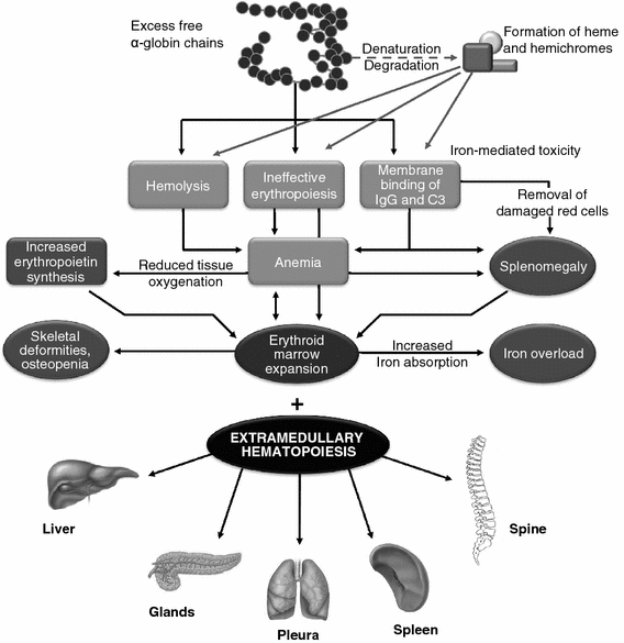 Paraspinal extramedullary hematopoiesis in patients with thalassemia ...