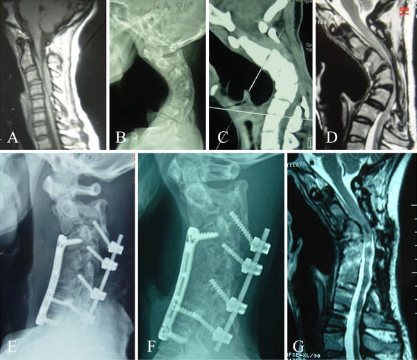 Surgical treatment of cervical kyphosis | SpringerLink
