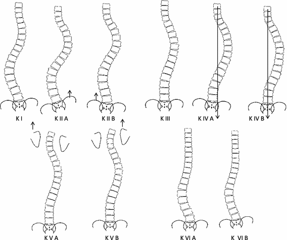 Taking the shoulders and pelvis into account in the preoperative ...