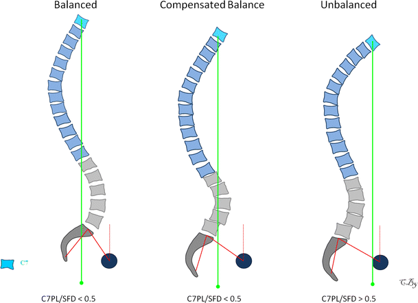 Sagittal balance disorders in severe degenerative spine. Can we ...