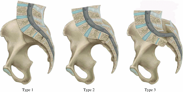 Surgical management of U-shaped sacral fractures: a systematic review ...