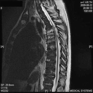 Empyema in spinal canal in thoracic region, abscesses in paravertebral ...