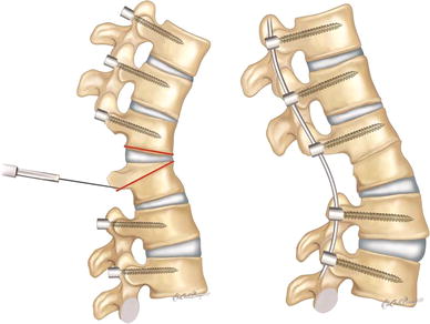 Osteotomies/spinal column resections in adult deformity | SpringerLink