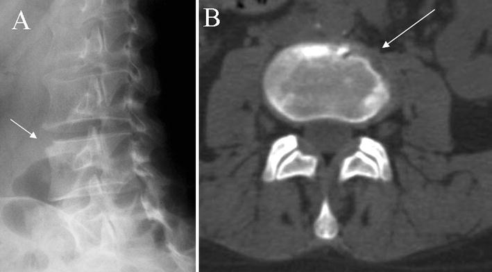 Imaging findings of Pott’s disease | SpringerLink