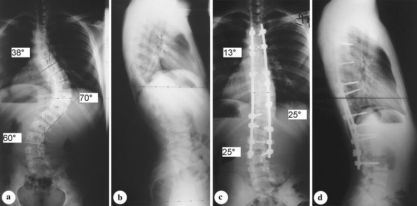 Reversing the concept: correction of adolescent idiopathic scoliosis ...