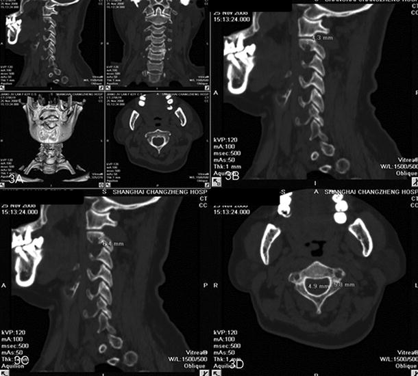 C1–2 transarticular screws combined with C1 laminar hooks fixation: a ...