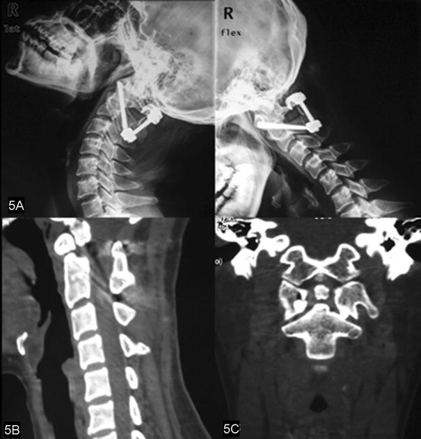 C1–2 transarticular screws combined with C1 laminar hooks fixation: a ...