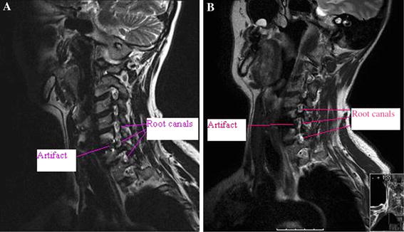 Magnetic resonance imaging evaluation after implantation of a titanium ...