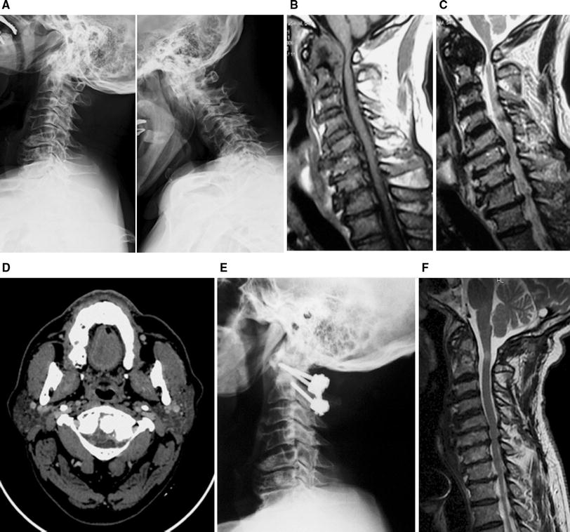 Disappearance of degenerative, non-inflammatory, retro-odontoid ...