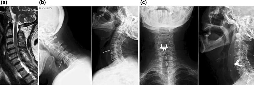Zero-P: a new zero-profile cage-plate device for single and multilevel ...