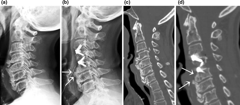 Zero-P: a new zero-profile cage-plate device for single and multilevel ...