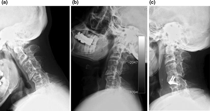 Zero-P: a new zero-profile cage-plate device for single and multilevel ...