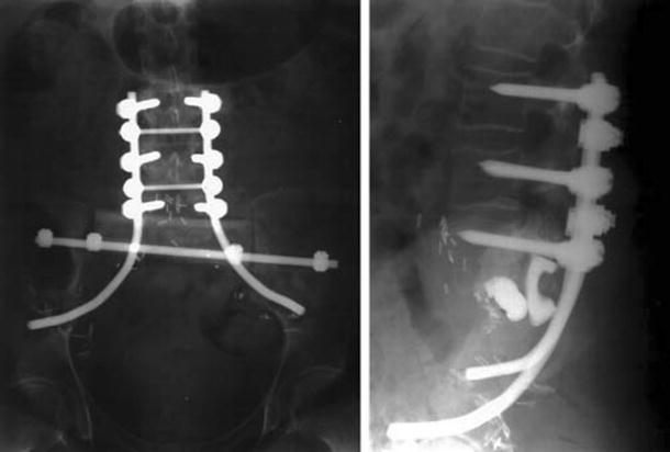 Surgical techniques for spinopelvic reconstruction following total ...