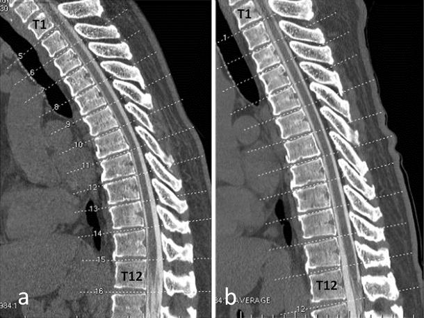 Range of motion of thoracic spine in sagittal plane | SpringerLink