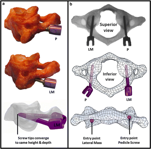 Biomechanical advantage of C1 pedicle screws over C1 lateral mass ...