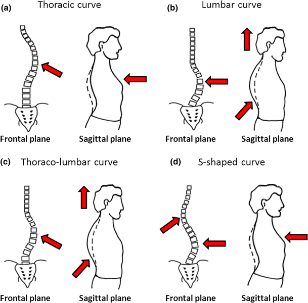 Active self-correction and task-oriented exercises reduce spinal ...