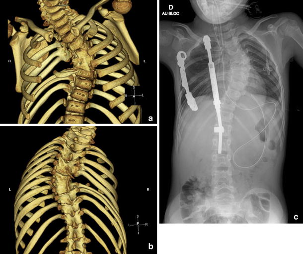 Treatment of congenital thoracic scoliosis with associated rib fusions ...