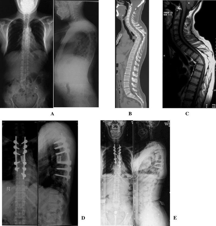 The posterior surgical treatment for focal kyphosis in upper-middle ...