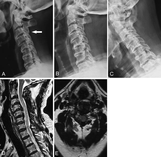 Extensive laminectomy for multilevel cervical stenosis with ligamentum ...