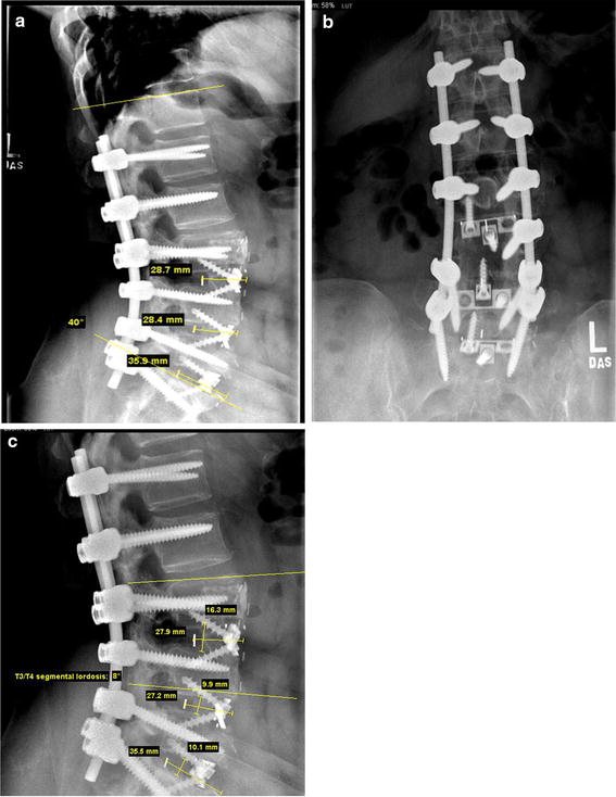 Radiological evaluation of anterior lumbar fusion using PEEK cages with ...