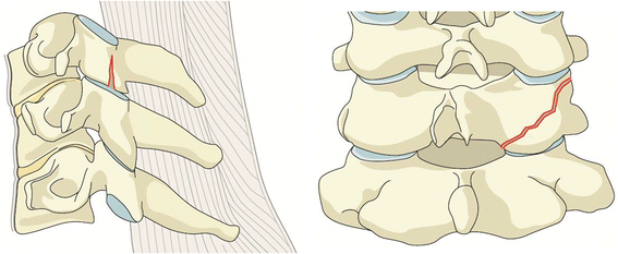 AOSpine subaxial cervical spine injury classification system | SpringerLink