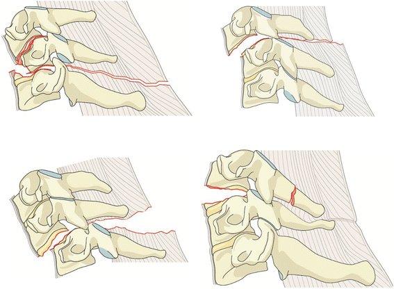 AOSpine subaxial cervical spine injury classification system | SpringerLink