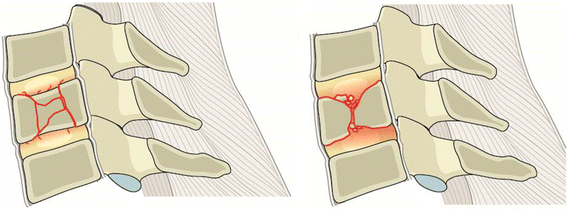 AOSpine subaxial cervical spine injury classification system | SpringerLink