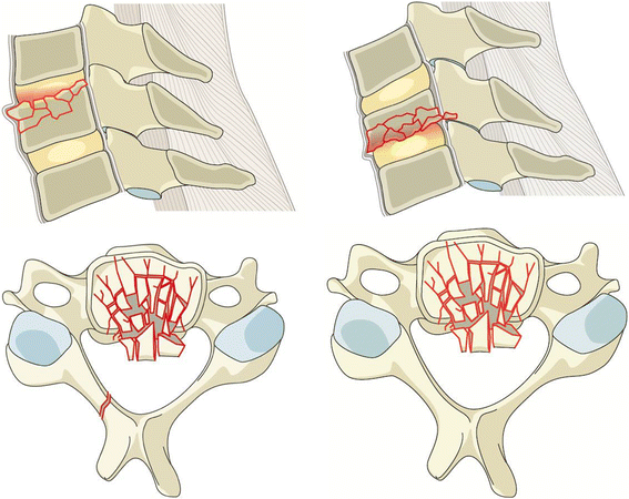 AOSpine subaxial cervical spine injury classification system | SpringerLink