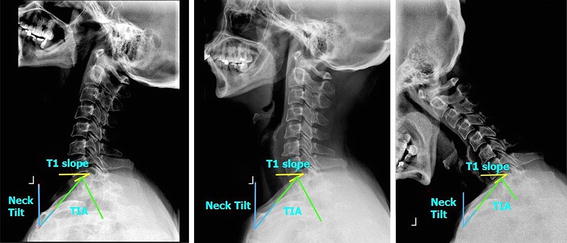 Influence of cervical spine position on the radiographic parameters of ...