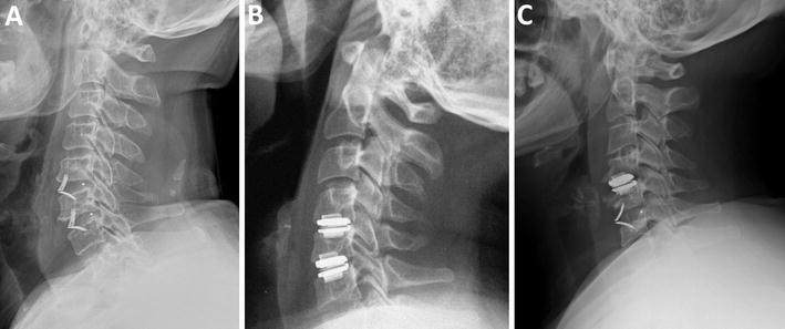 Clinical and radiological features of hybrid surgery in multilevel ...