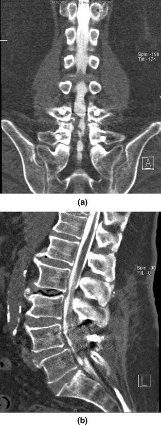 Spinal metallosis: a systematic review | SpringerLink