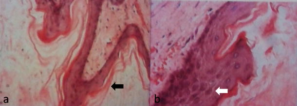 A rare cause of recalcitrant coccydynia: benign dermoid cyst ...