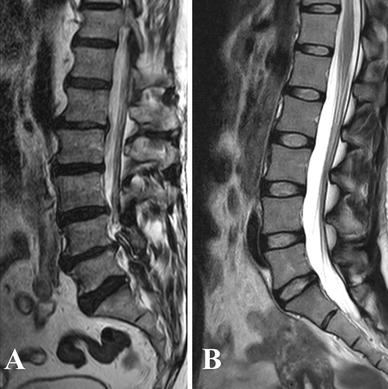 The Pfirrmann classification of lumbar intervertebral disc degeneration ...