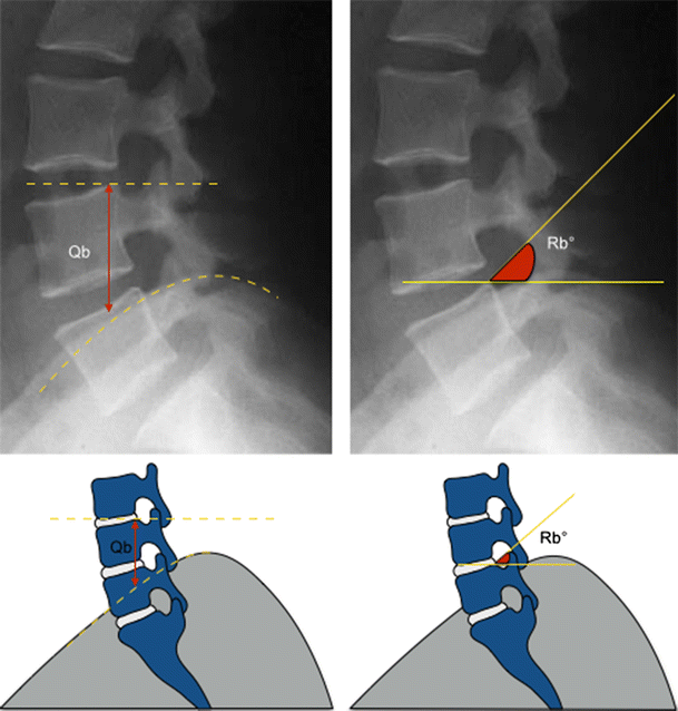 Radiographic measurement for transforaminal percutaneous endoscopic ...