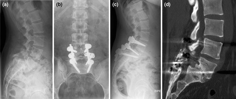 Transdiscal screw versus pedicle screw fixation for high-grade L5-S1 ...