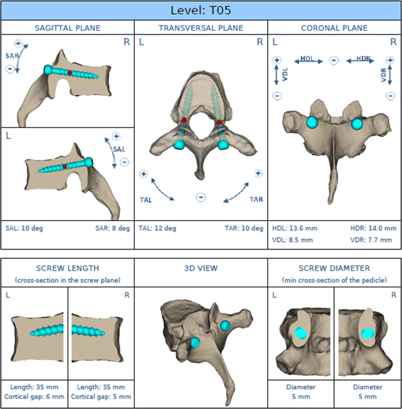 Accuracy of patient-specific template-guided vs. free-hand ...