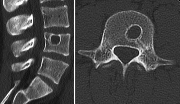 Solitary bone cyst of a lumbar vertebra treated with percutaneous ...