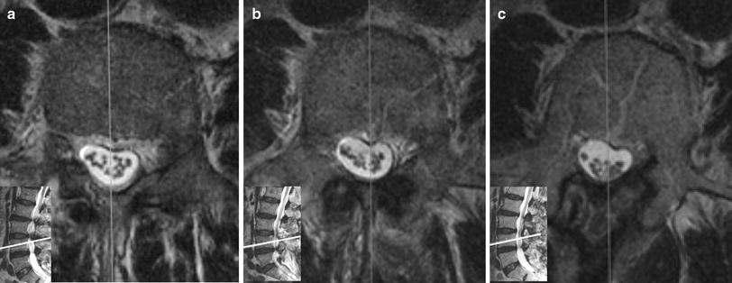 Reversibility of nerve root sedimentation sign in lumbar spinal ...