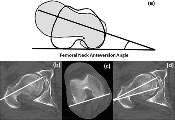 Spinopelvic parameter changes and low back pain improvement due to ...
