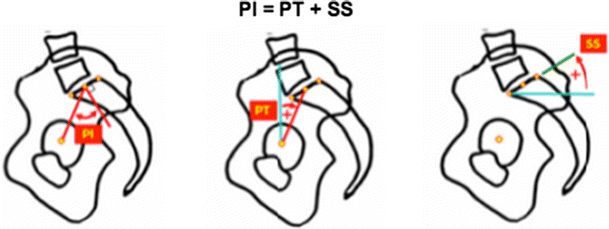 Classification of normal sagittal spine alignment: refounding the ...