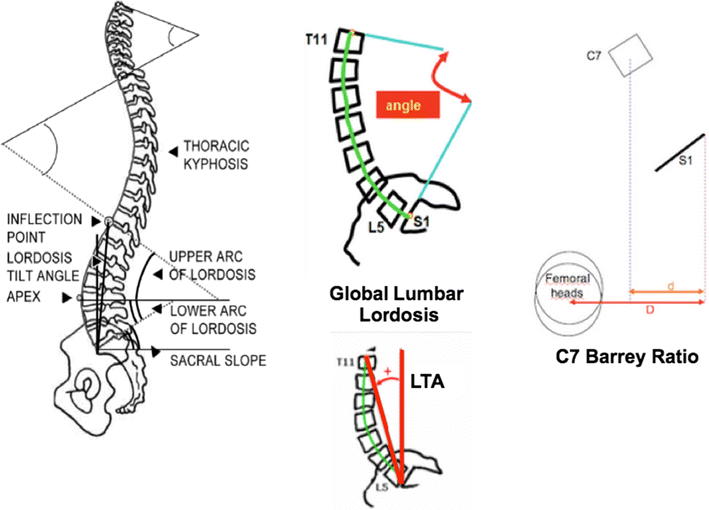 Classification of normal sagittal spine alignment: refounding the ...