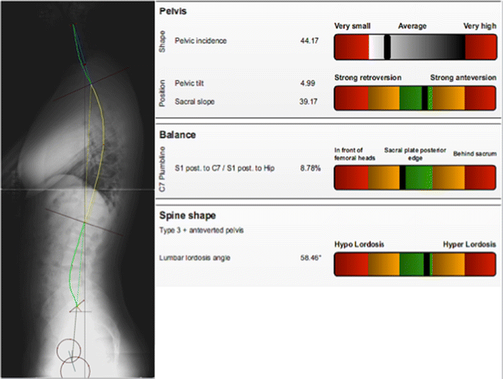 Classification of normal sagittal spine alignment: refounding the ...