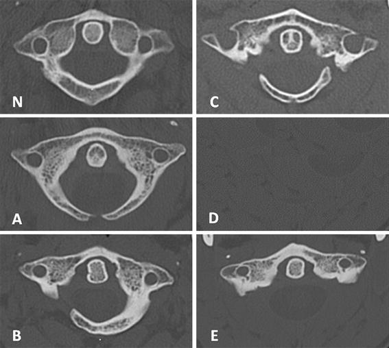 The prevalence of congenital C1 arch anomalies | SpringerLink