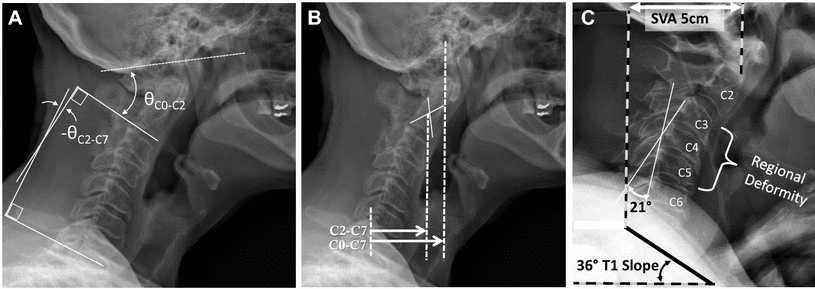 Cervical sagittal balance: a biomechanical perspective can help ...