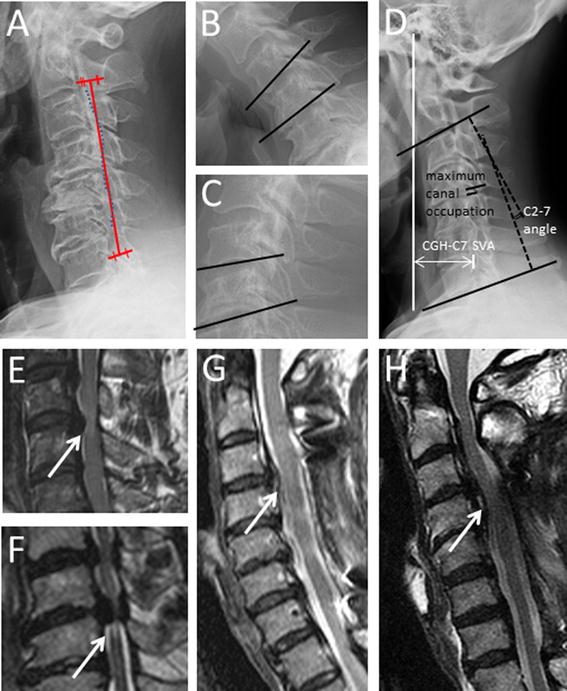 Postoperative K-line conversion from negative to positive is ...