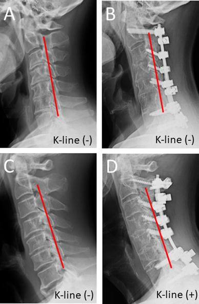 Postoperative K-line conversion from negative to positive is ...